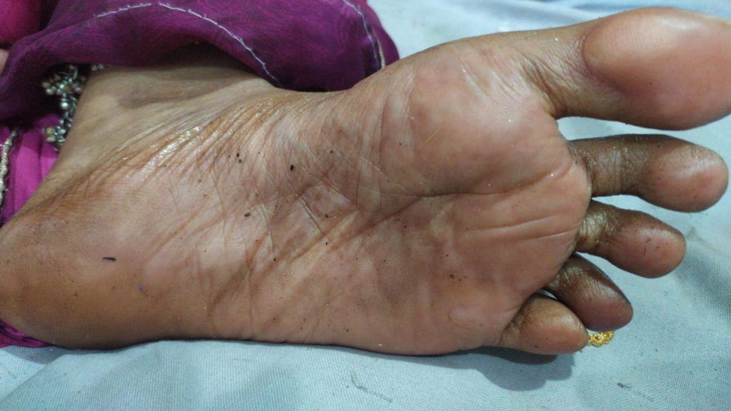 Diabetic foot Pre Gangrene Mrs Gaury - Welcome to Dr. Amina's Royal ...