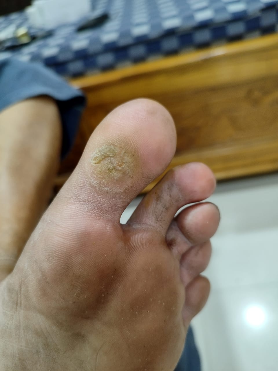 Diabetic Foot Ulcer / Gangrene - Omprakash Srivastava - Welcome to Dr ...