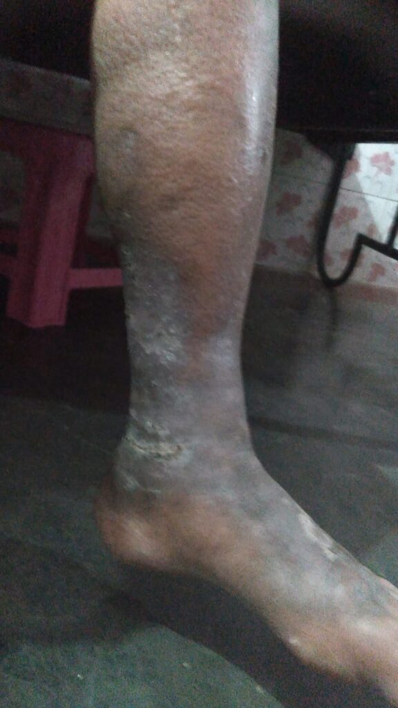 Chandra - Diabetic foot Ulcer / Gangrene - Welcome to Dr. Amina's Royal ...