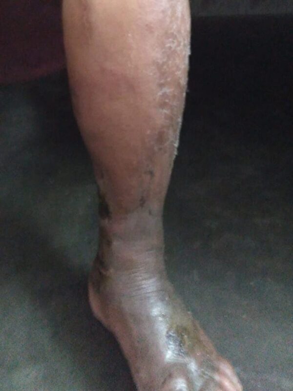 Chandra - Diabetic foot Ulcer / Gangrene - Welcome to Dr. Amina's Royal ...